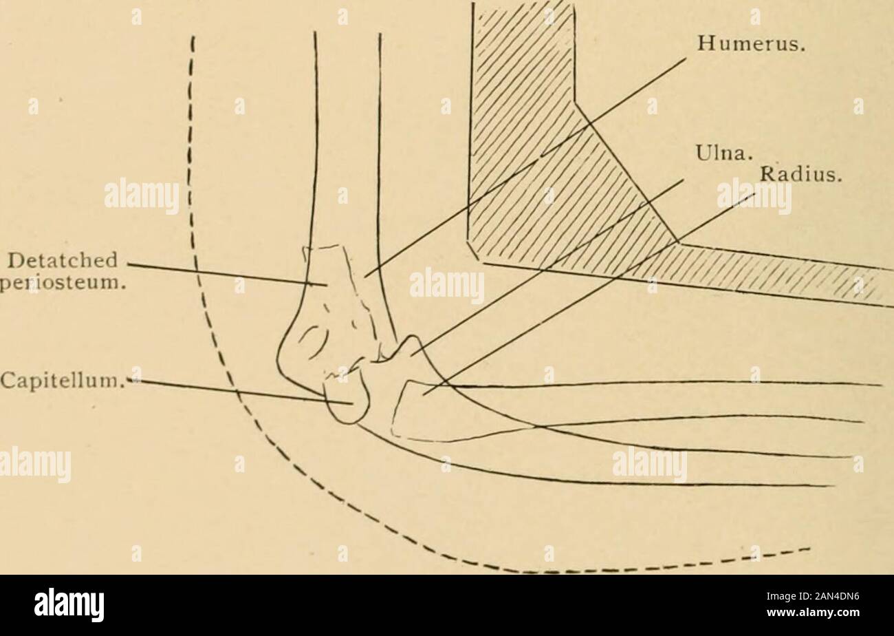 The treatment of fractures . Epiphysis. Shaft of humerus. Ulna. Fig ...