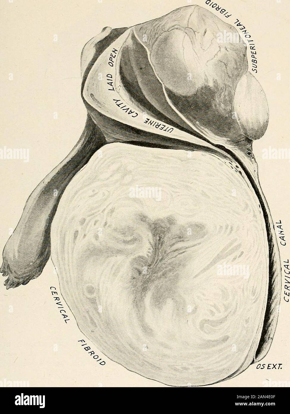 Gynaecology for students and practitioners . Fig. 217. Interstitial ...