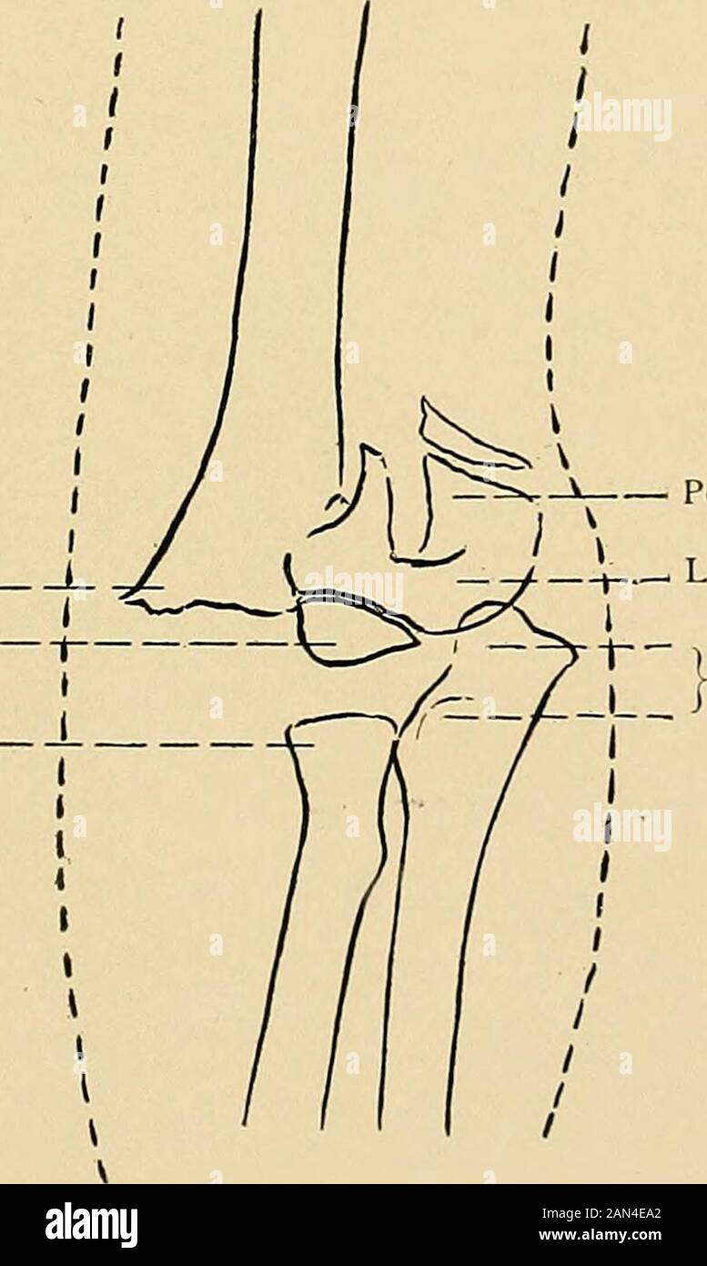 The treatment of fractures . Epiphysis. Capitellum. pjo- 207 ...
