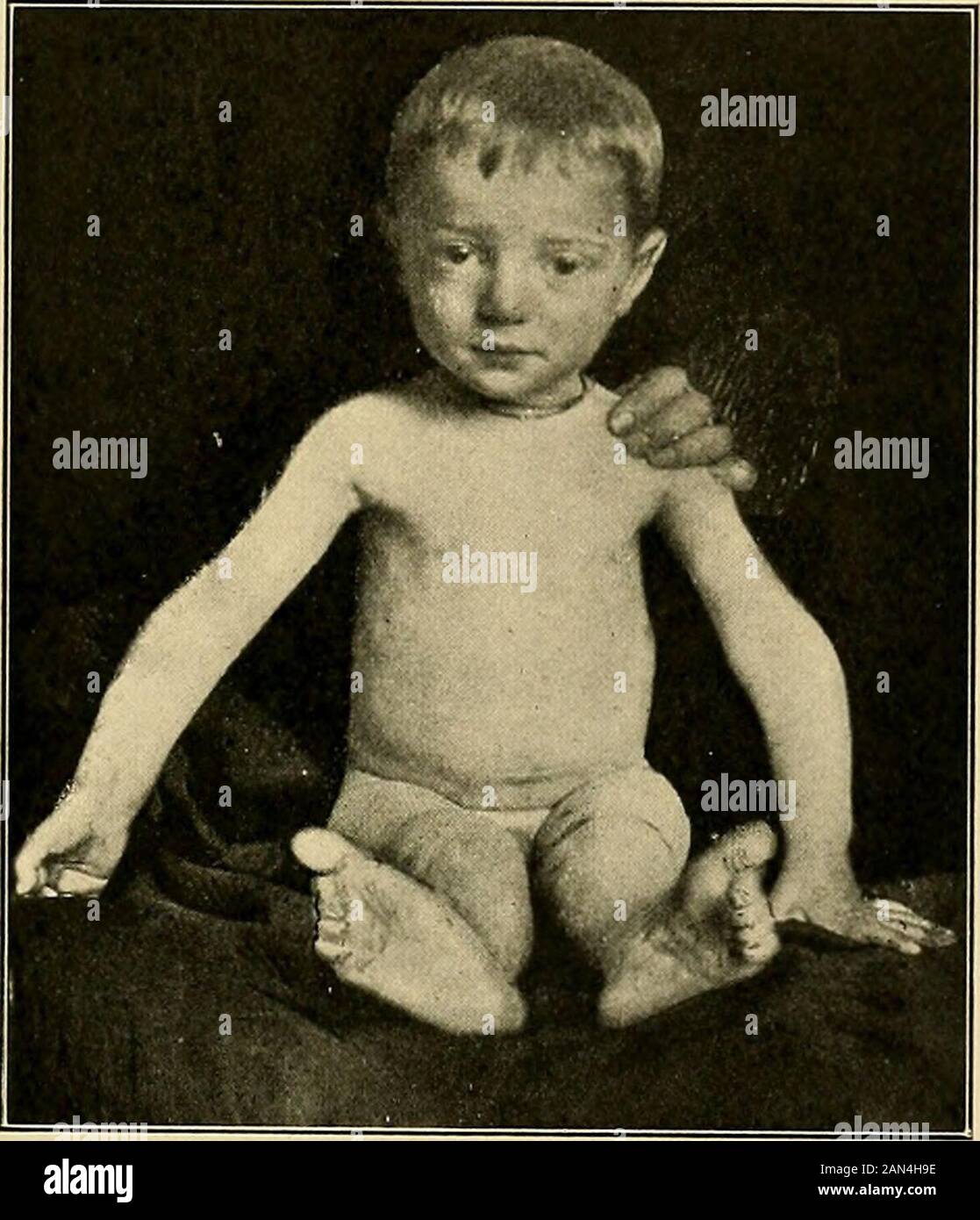 The treatment of fractures . • External condyle. y— Capitellum. P.adius ...