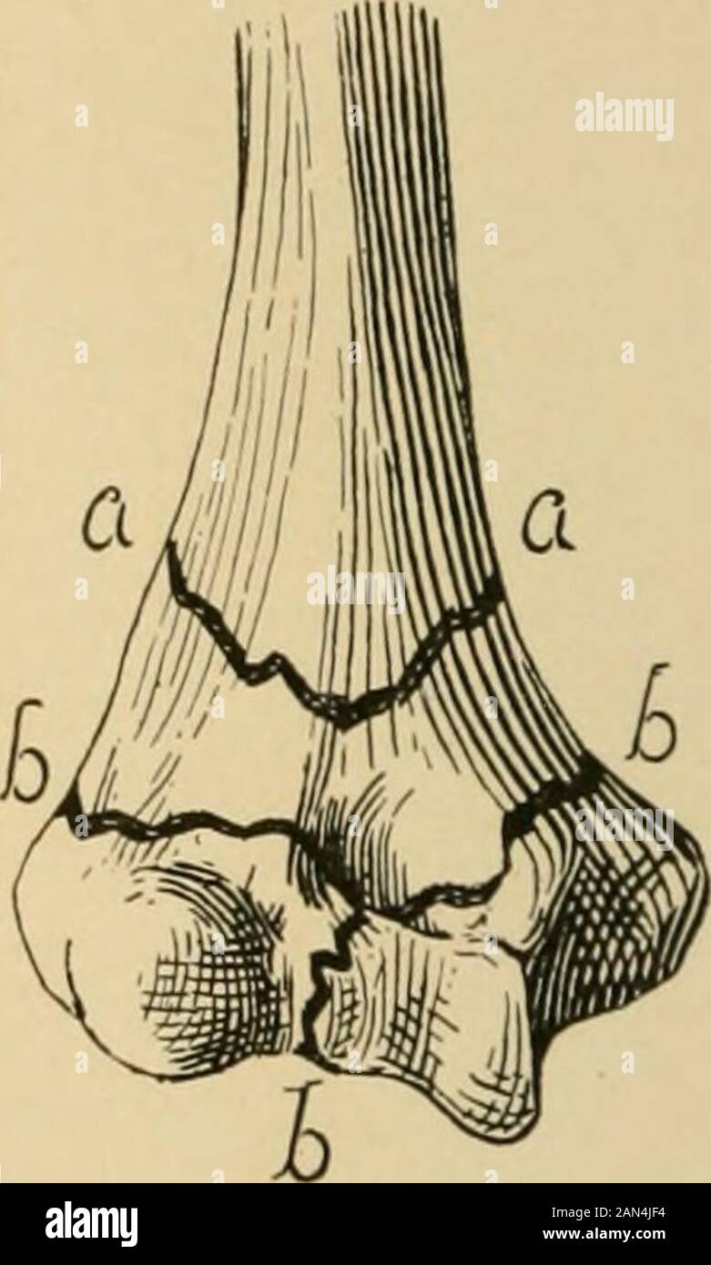 The treatment of fractures . Fig. 196.—T-fracture, high (a,