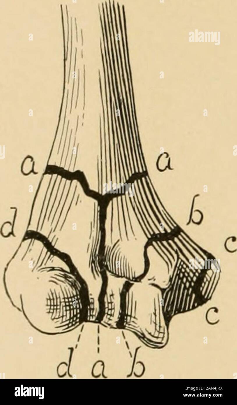 The treatment of fractures . ubluxation of the radial head. ( c ...