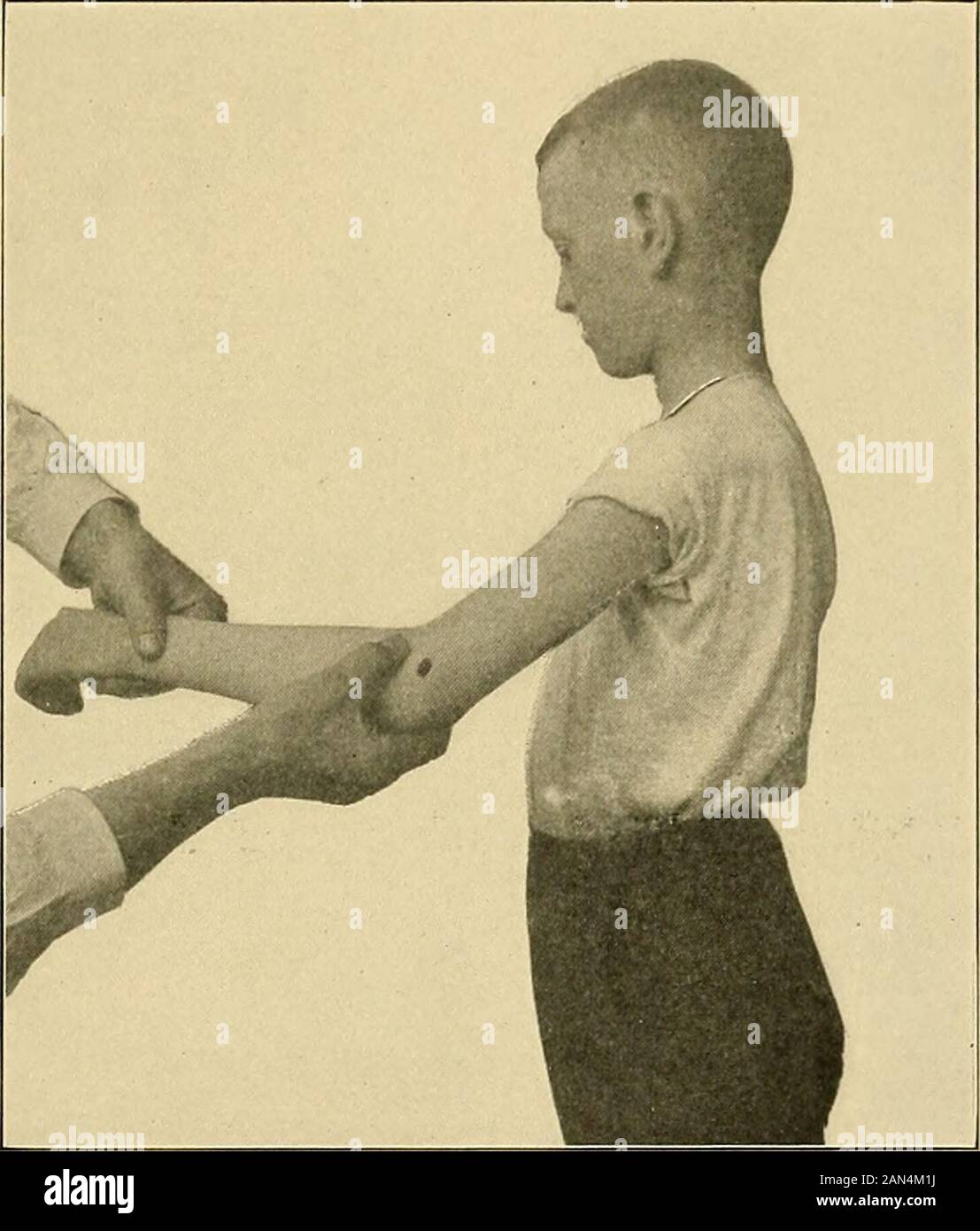 The treatment of fractures . Fig. 191.—Position of supination, showing ...