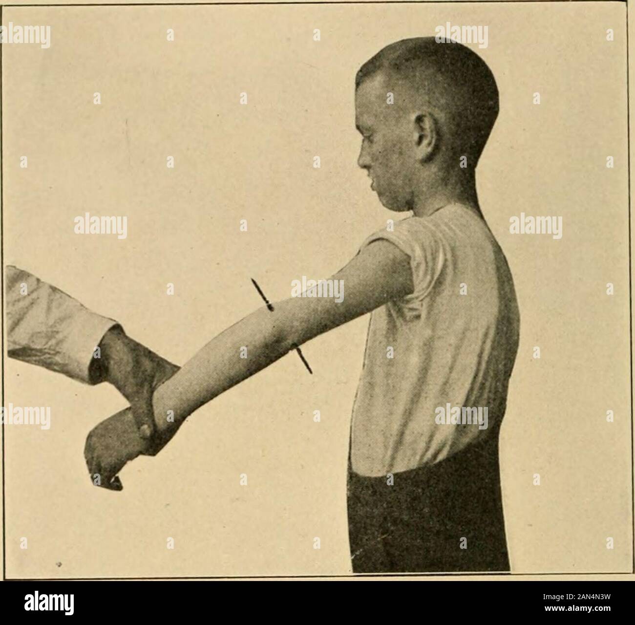 Olecranon Process Palpation