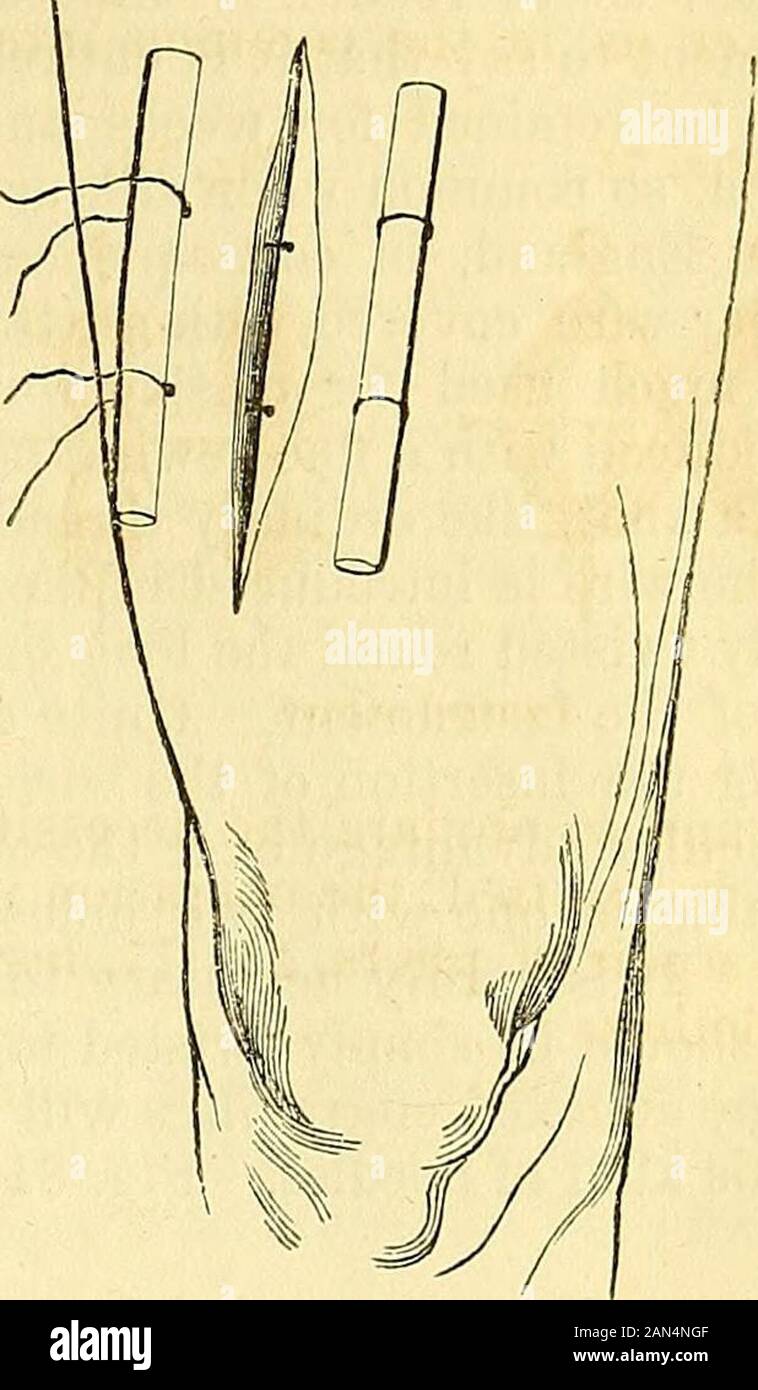 Continued suture hi-res stock photography and images - Alamy