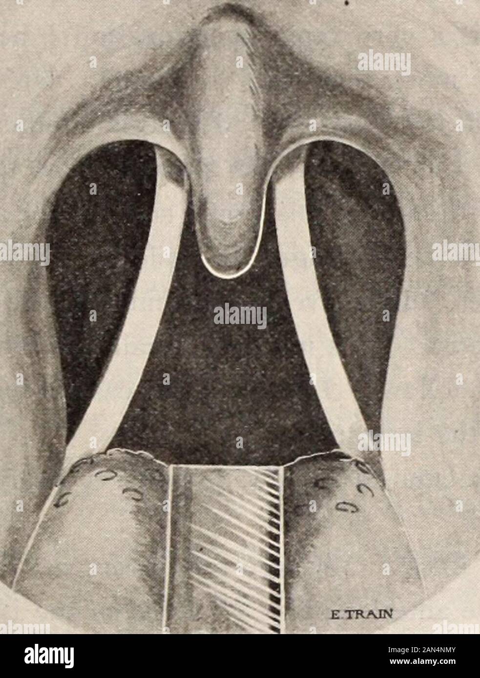 Tonsillectomy Anatomy