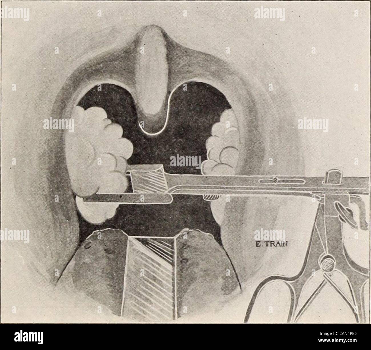 Journal of ophthalmology, otology and laryngology . .—Drawing of a ...