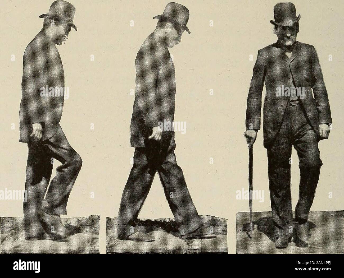 Nervous and mental diseases . Fig. 115.—Drop-foot and deformities in ...