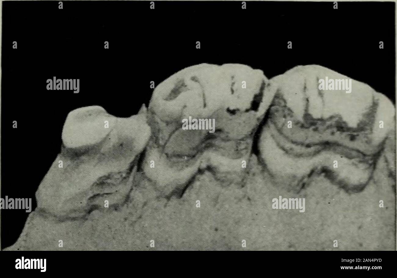 Wedge defect hi-res stock photography and images - Alamy