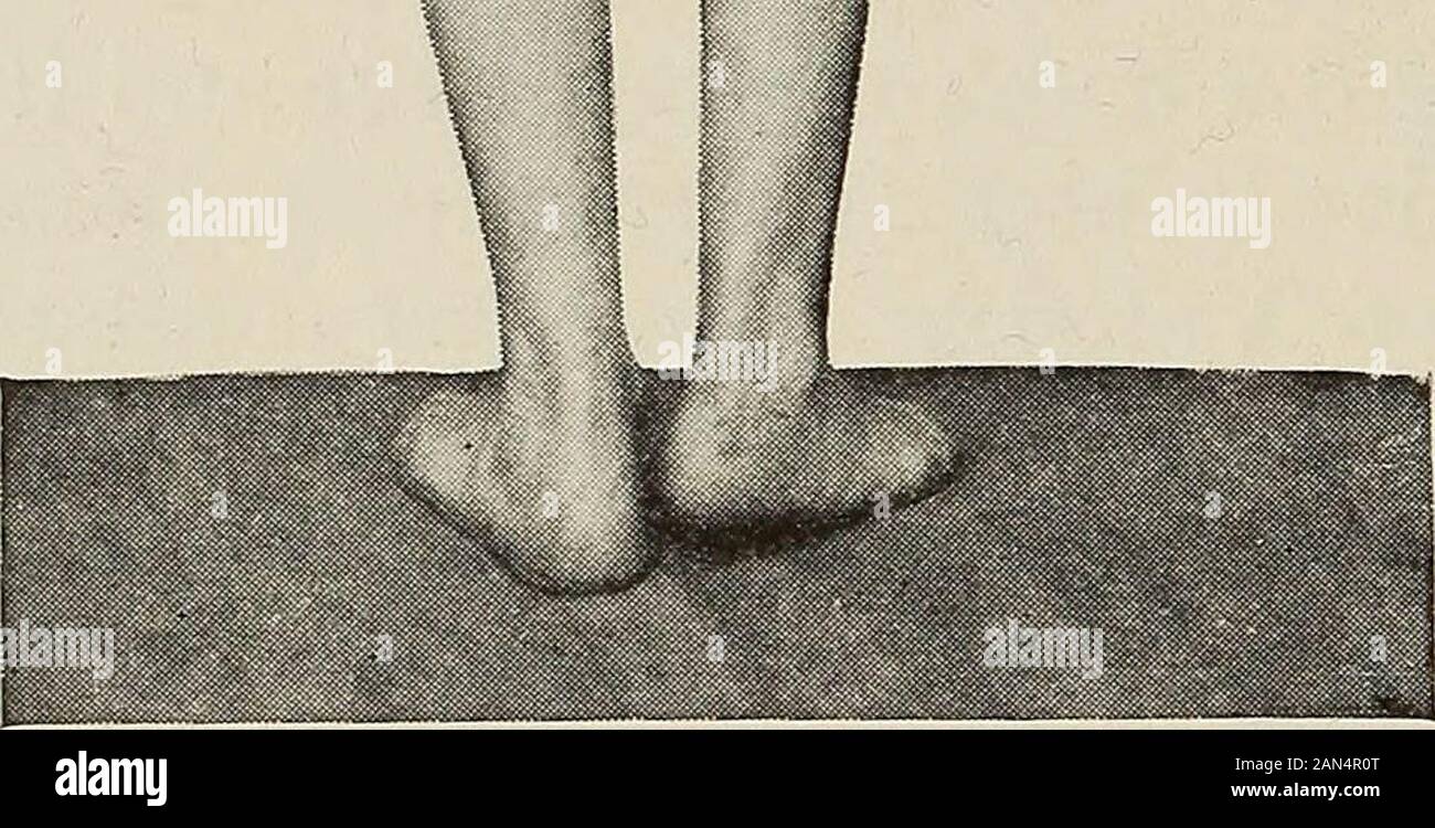 Babinski sign hi-res stock photography and images - Alamy