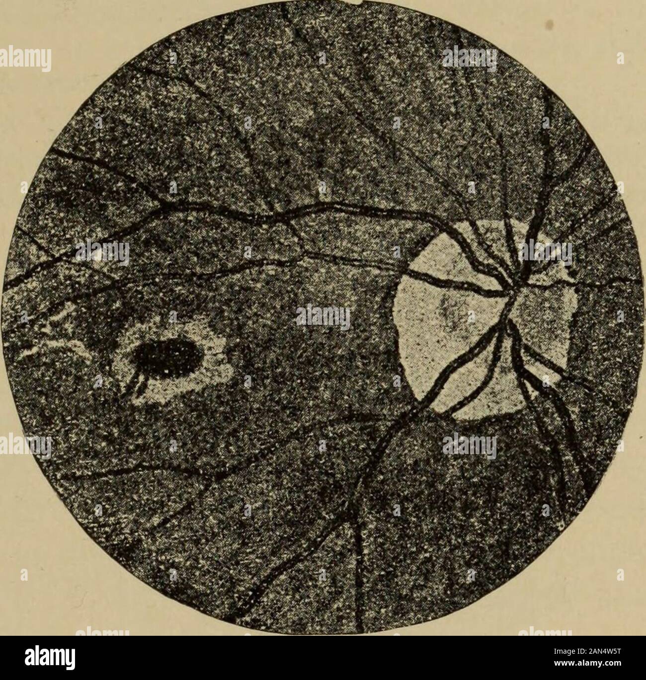 Text-book of ophthalmology . arance the acquired crescents due to ...