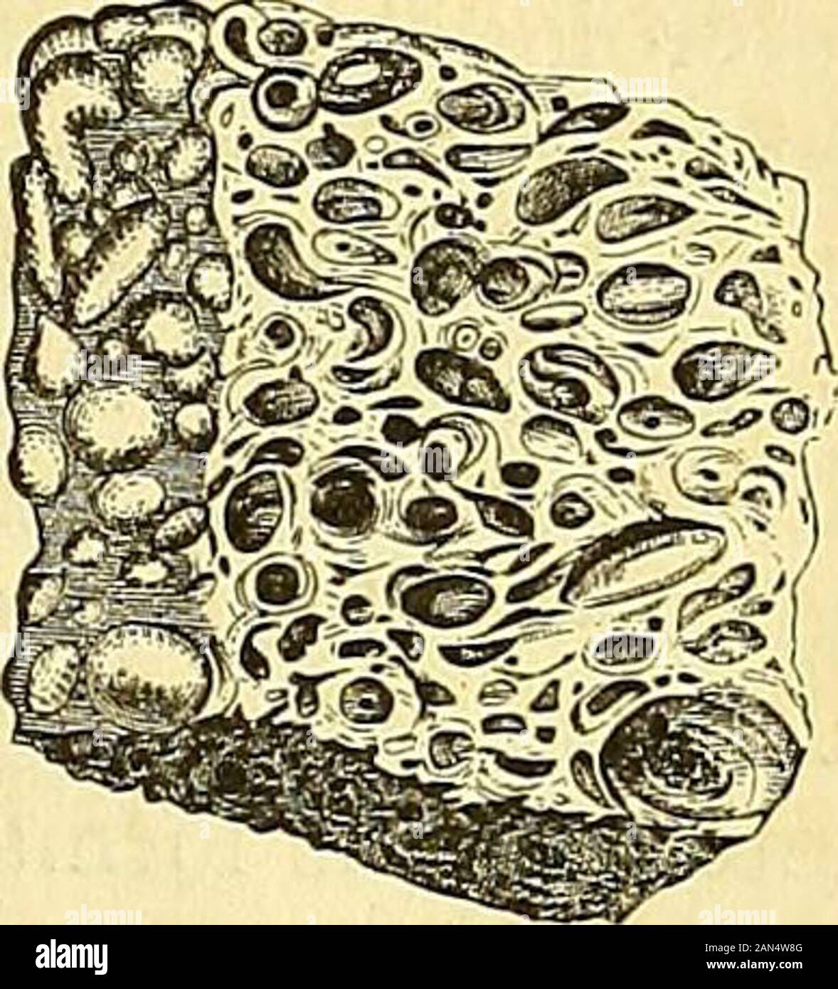 Colloid cysts hi-res stock photography and images - Alamy