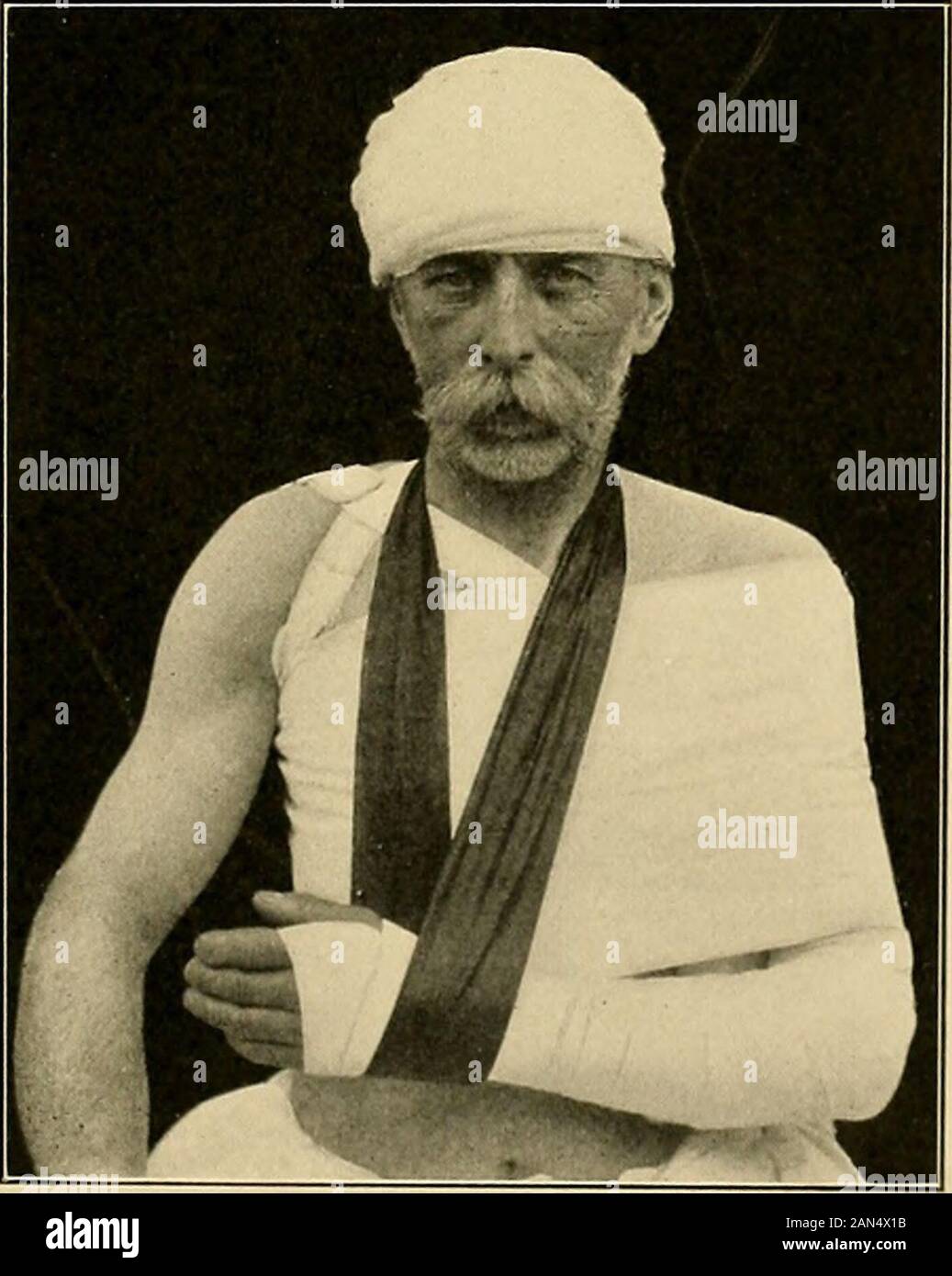 The treatment of fractures . Fis 175.—Fracture of the shaft of the ...