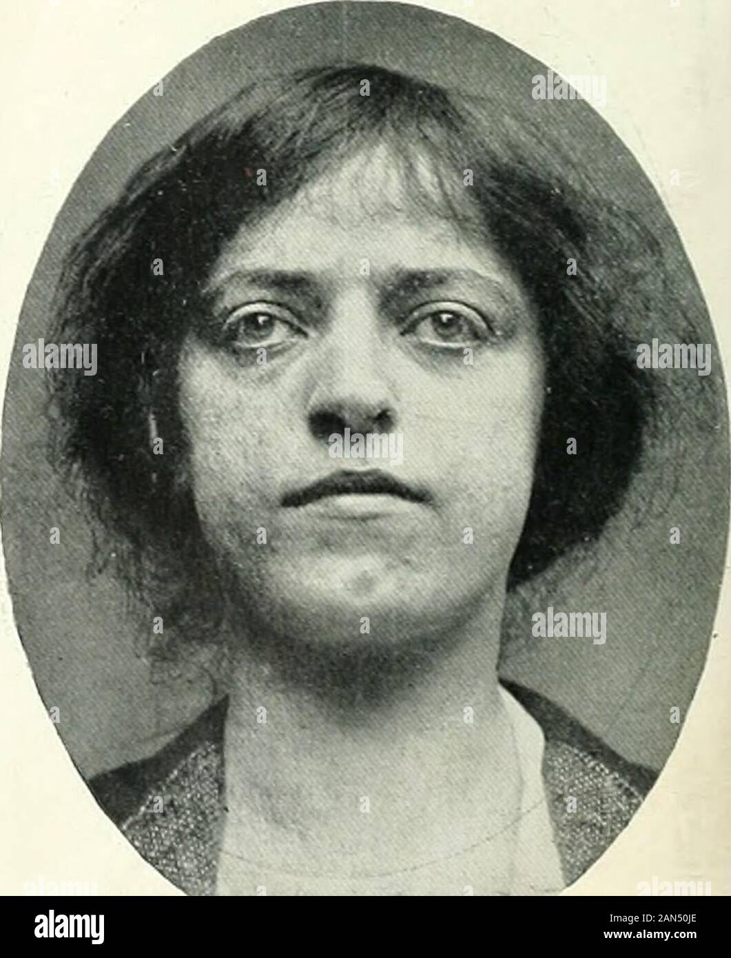 Exophthalmic goitre hi-res stock photography and images - Alamy