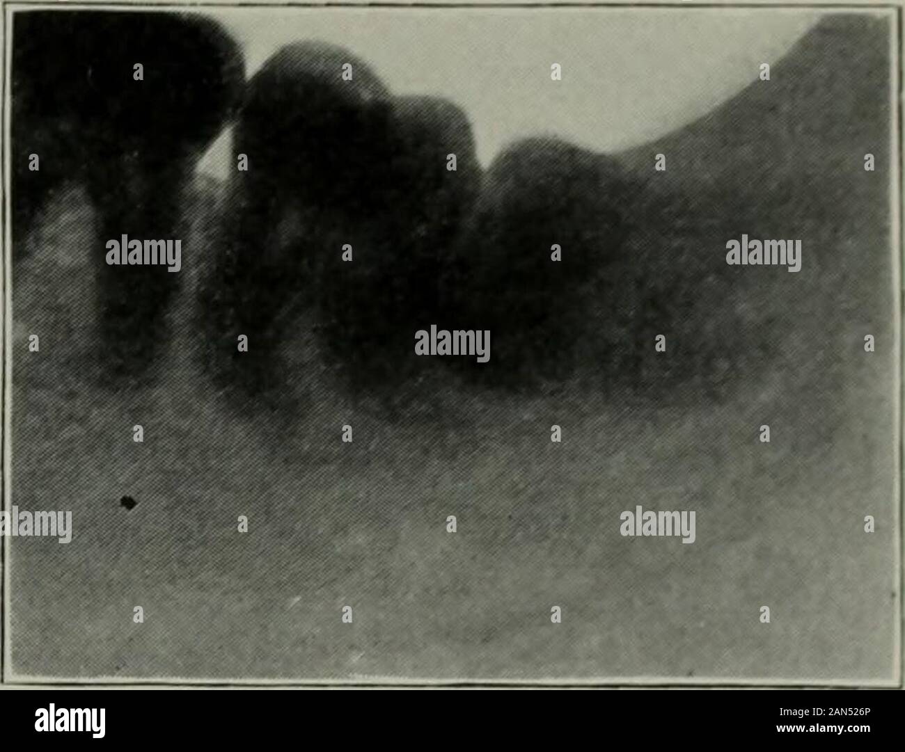 The Dental cosmos . A third molar in tlie horizontal positionwhich was ...