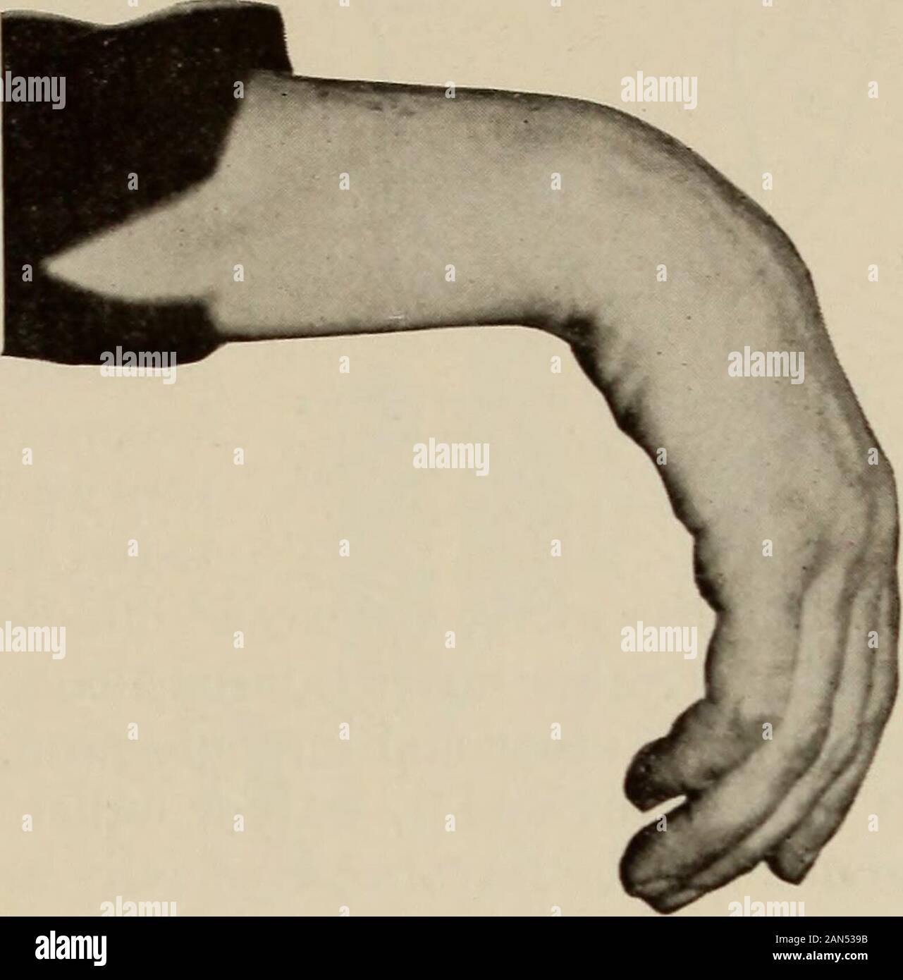 Nervous and mental diseases . Fig. 104.—Characteristic position of hand ...