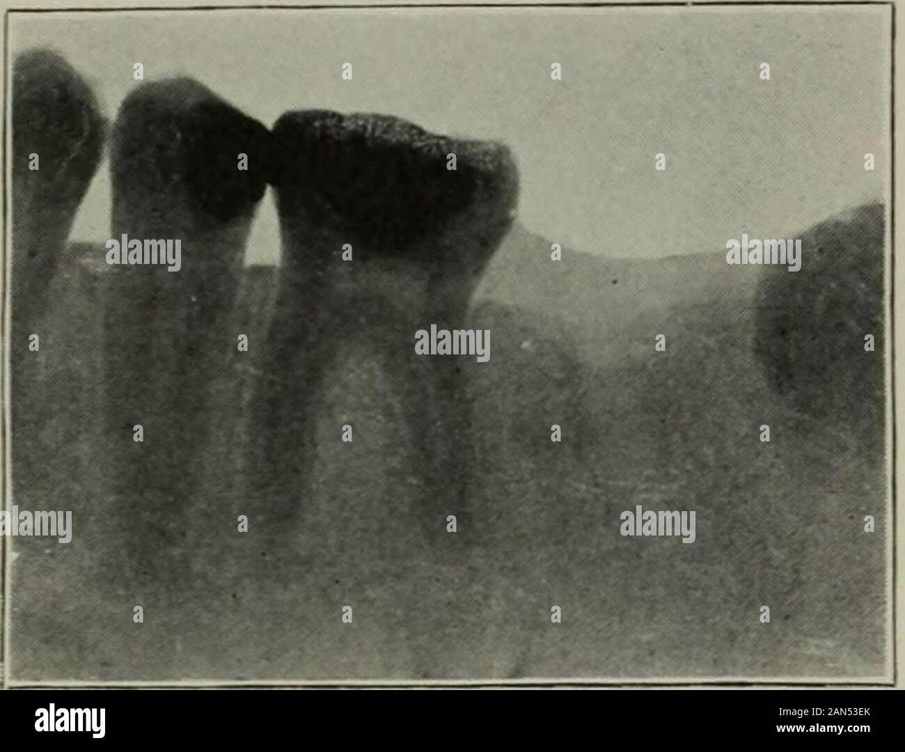 The Dental cosmos . An interesting case showing the normaland abnormal ...