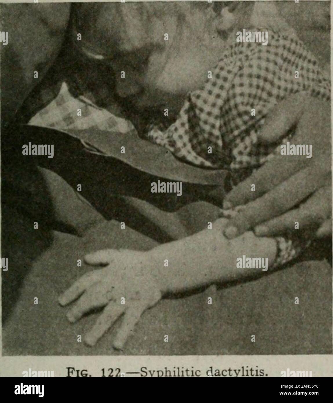 Syphilis rash hi-res stock photography and images - Alamy