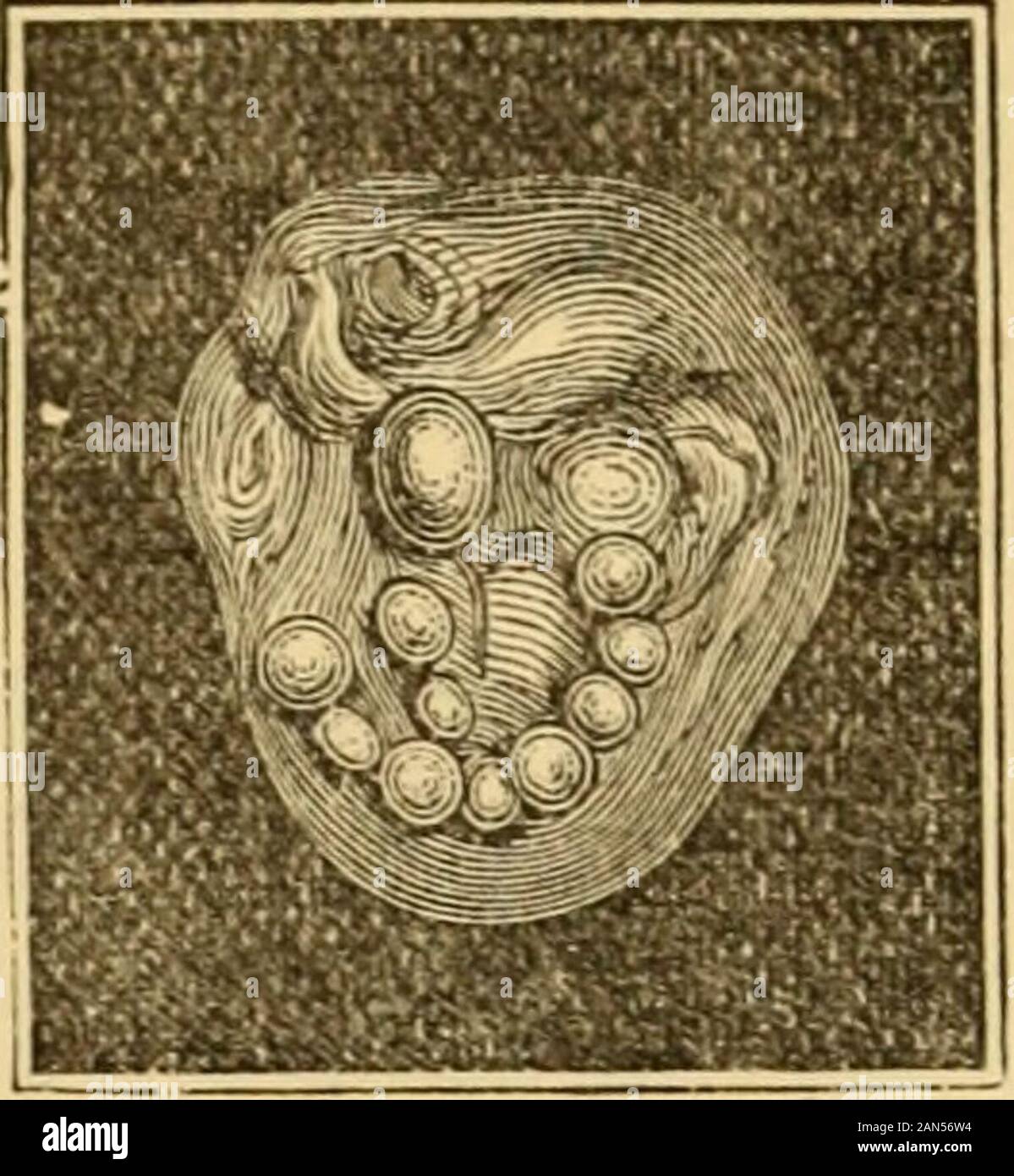 Myringitis hi-res stock photography and images - Alamy