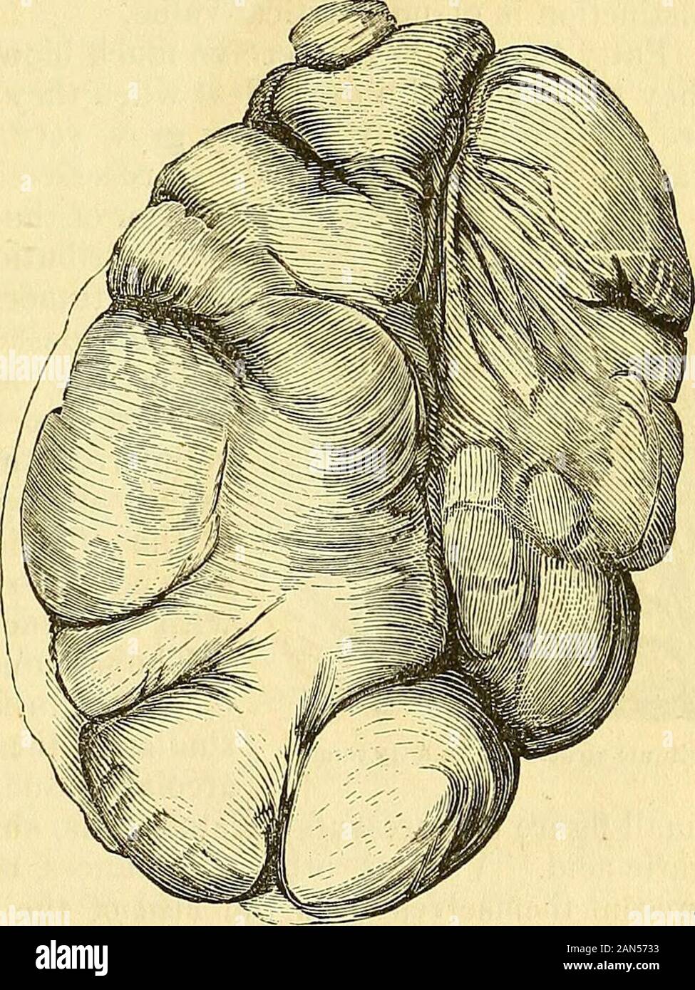 Scrotum surgery hi-res stock photography and images - Alamy