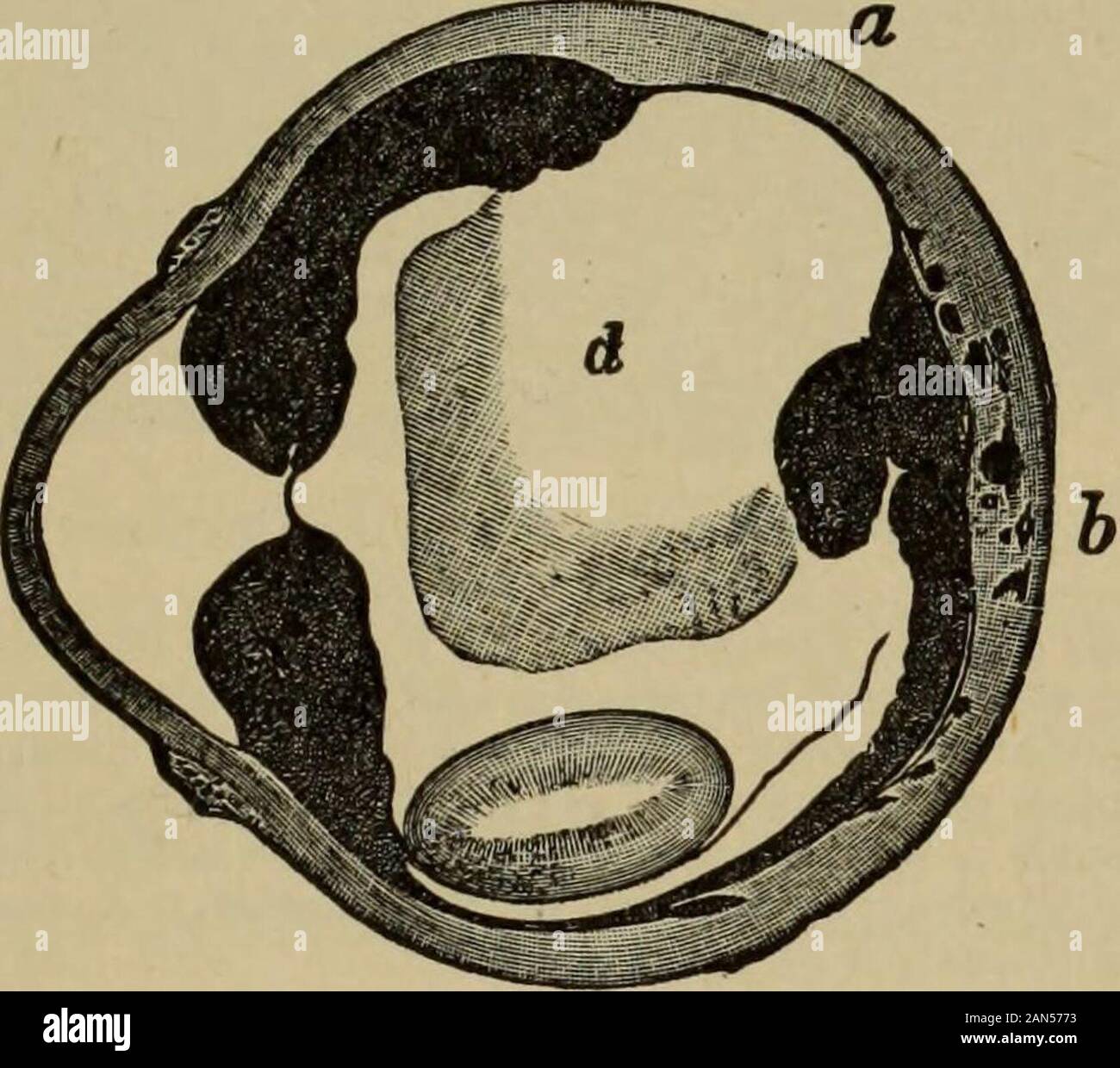 Text-book of ophthalmology . capsulated, we call it an abscess of the ...