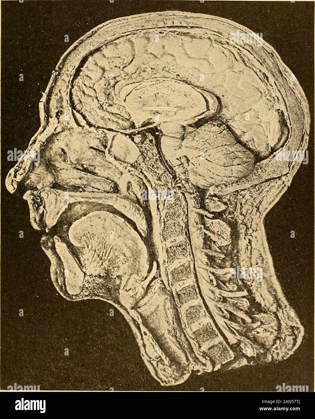 Brain surgery . FlG. 55.—The Cerebral Axis. Basal Ganglia. Crura. Pons ...