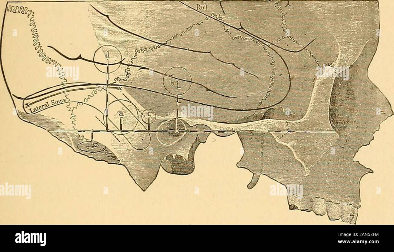 Brain surgery . bellum; and the best positions for trephining toreach ...