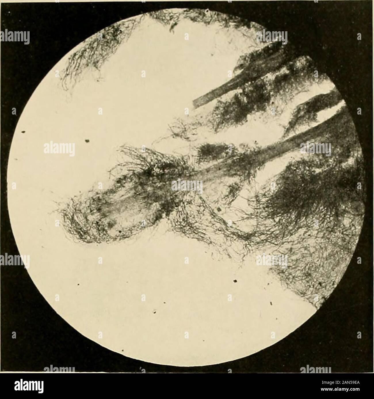 Ringworm of the scalp hi-res stock photography and images - Alamy