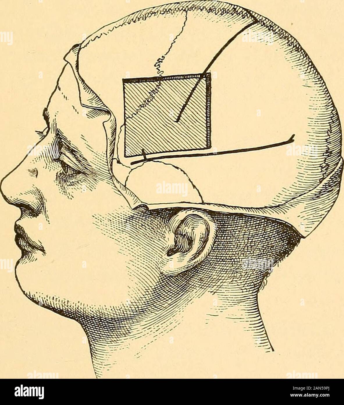 Brain surgery . he right hand and arm. Ophthalmoscopic ...
