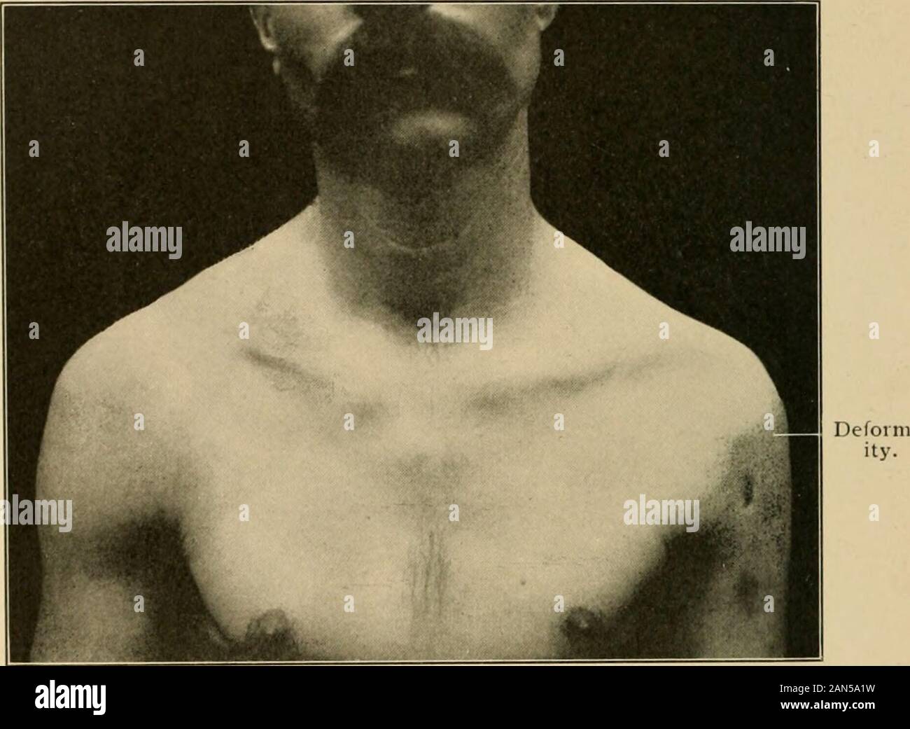 The treatment of fractures . the shoulder is flattened.The acromial ...