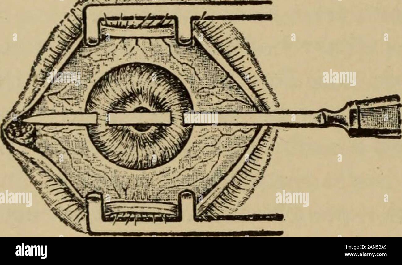 Text-book of ophthalmology . the posterior chamber,pressing the iris ...
