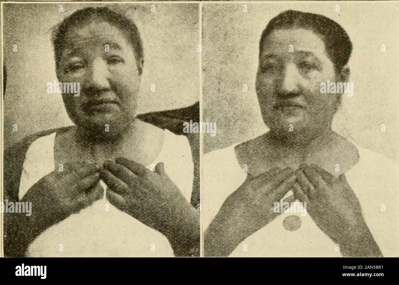 Myxedema hi-res stock photography and images - Alamy