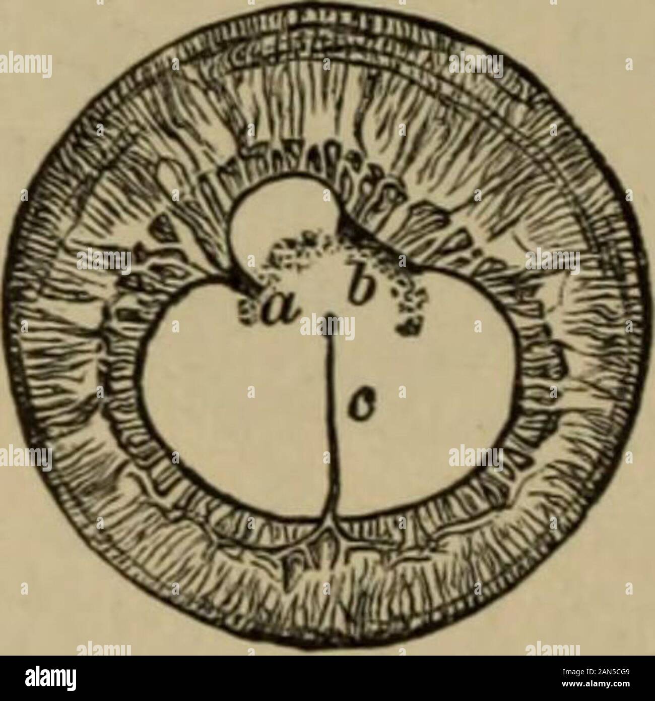 Posterior Synechiae Pigment On Lens