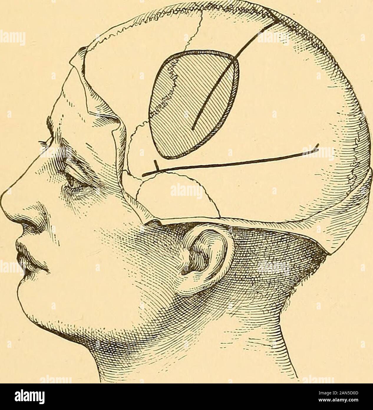 Brain surgery . her on May 15th, 1891. A piece of bone,about two inches ...
