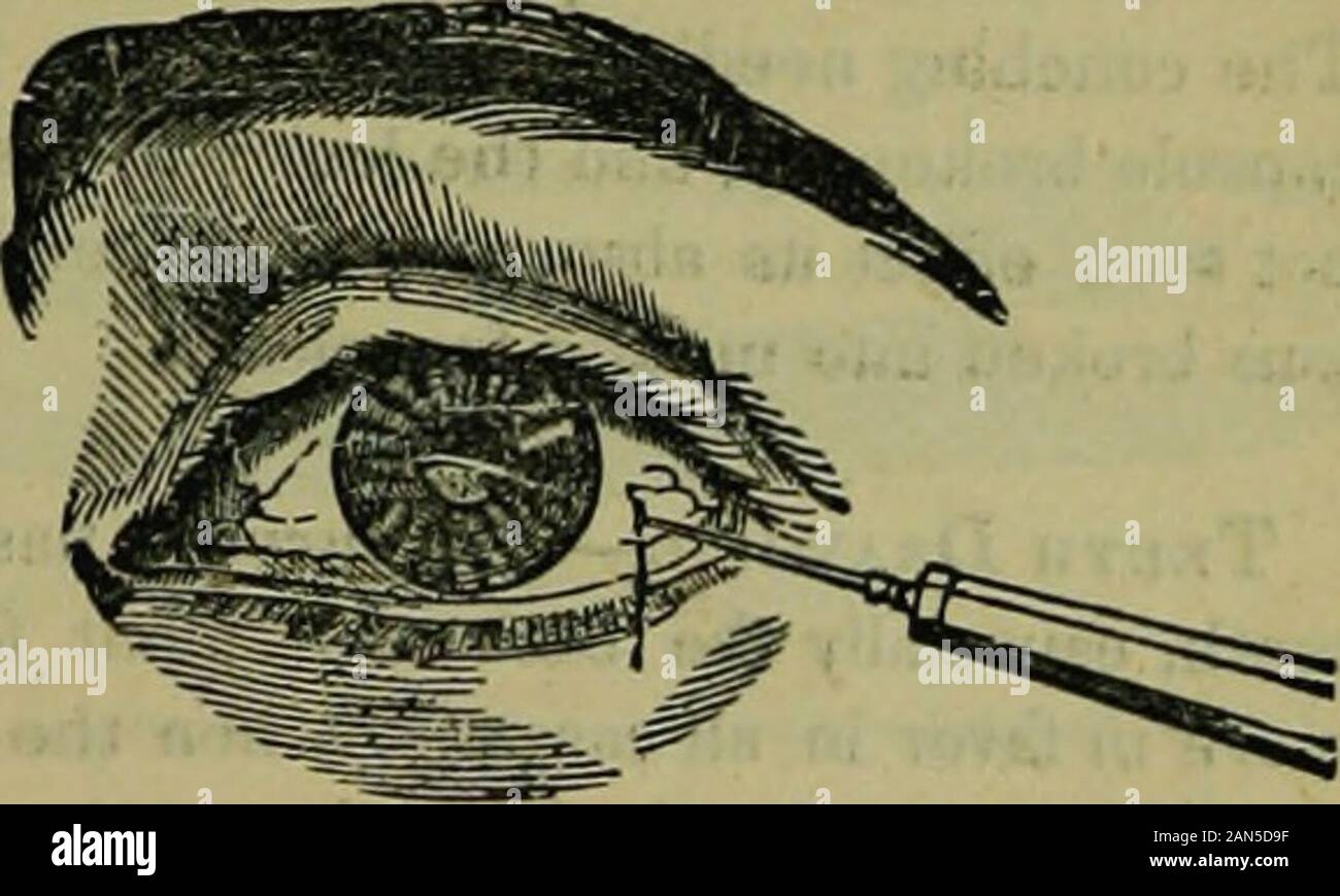 Eyelid retractor hi-res stock photography and images - Alamy
