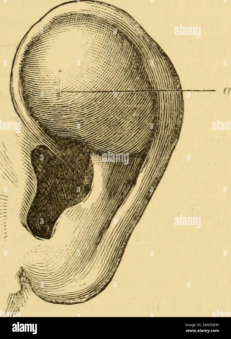 Othematoma hi-res stock photography and images - Alamy