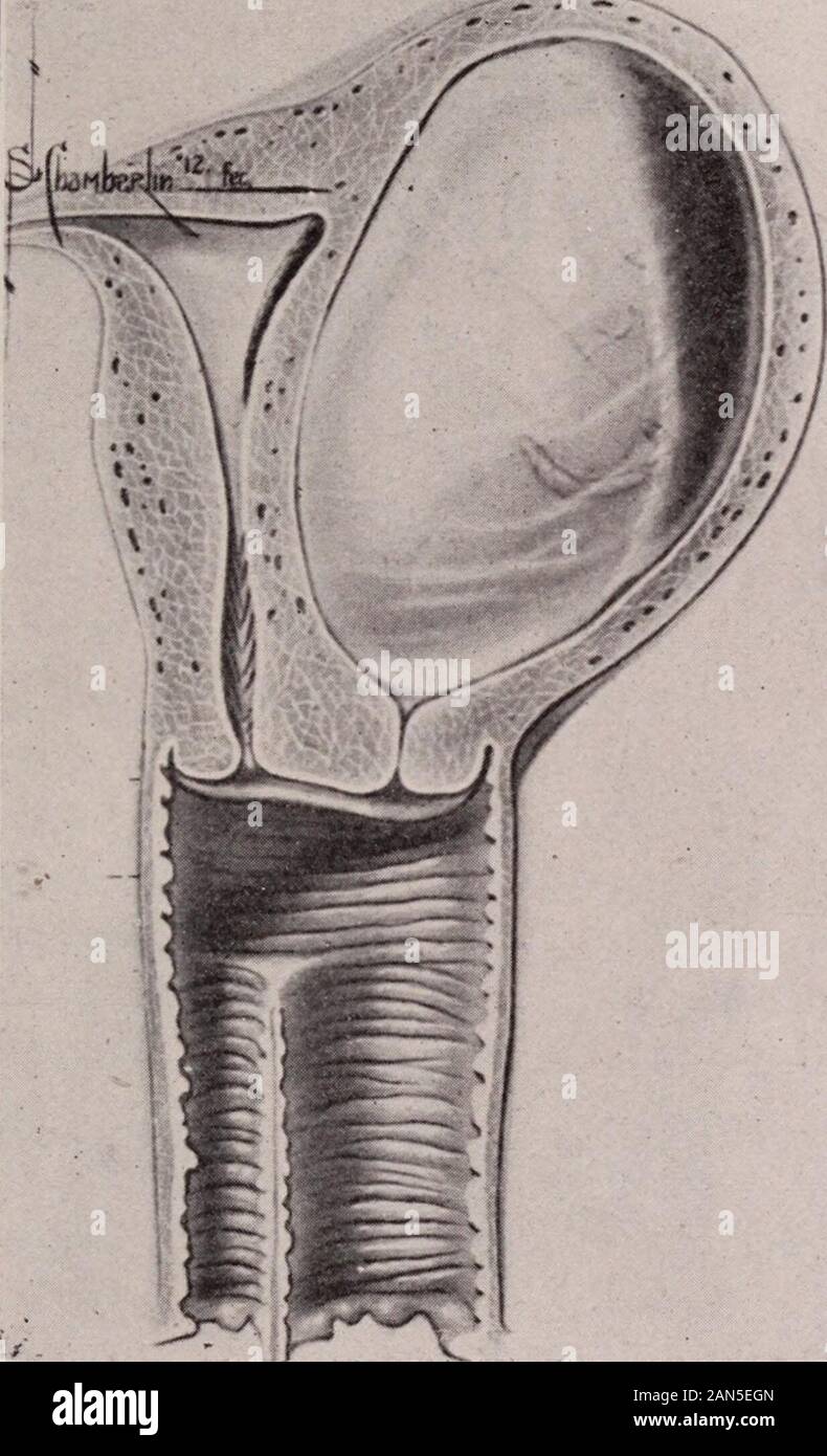 Double uterus hi-res stock photography and images - Alamy