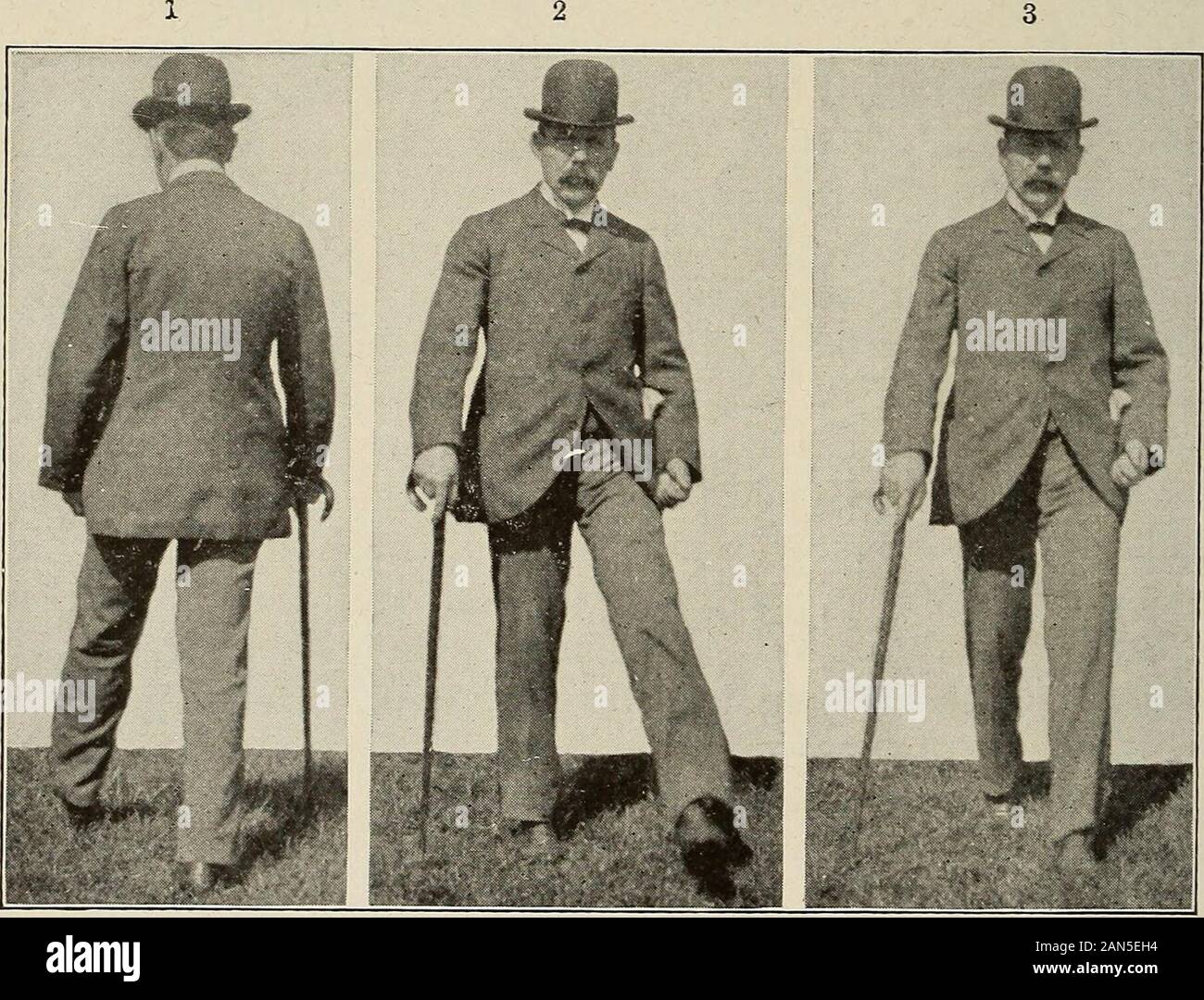 Nervous and mental diseases . Fig. 86.—Contractu red positions in ...