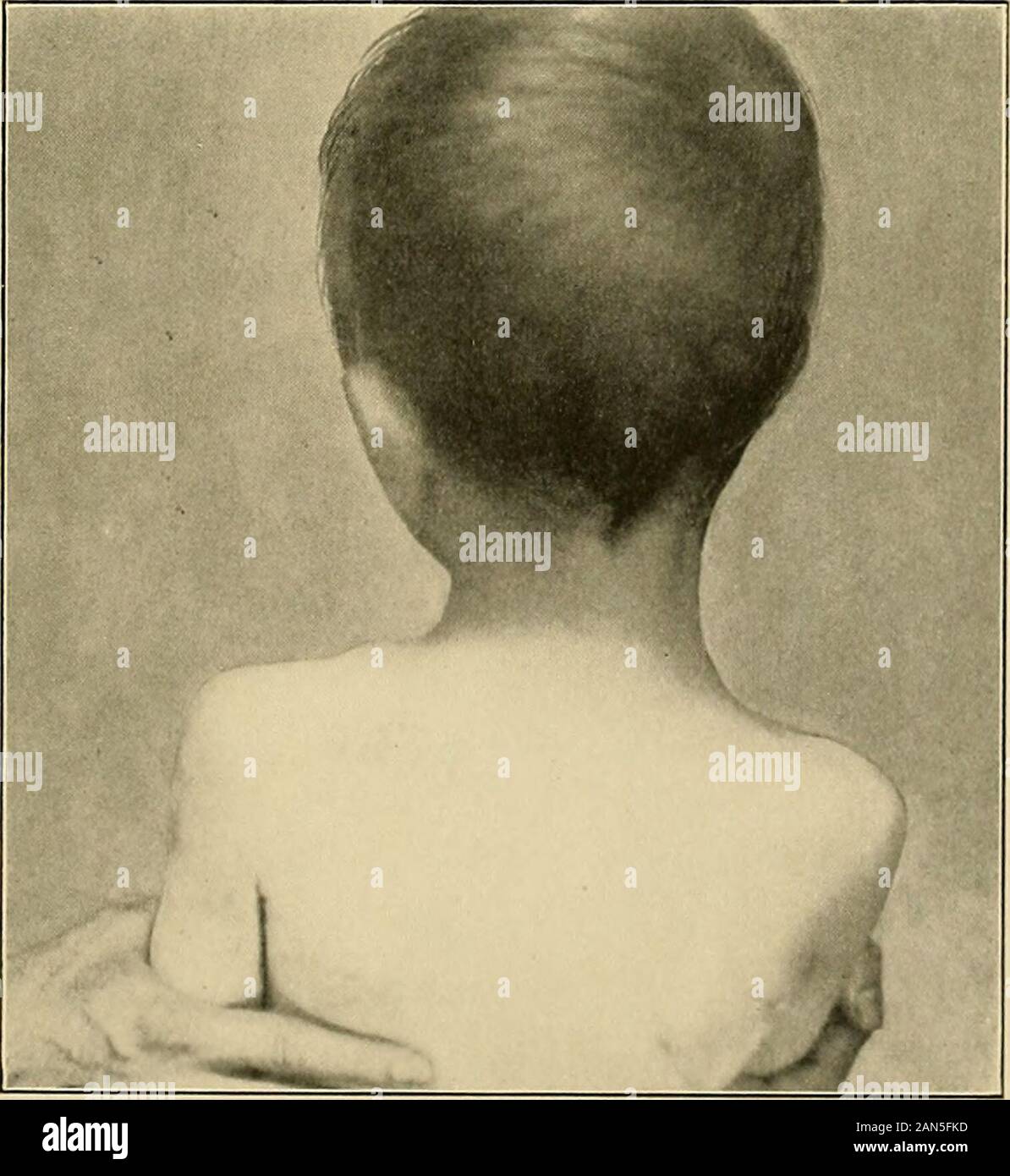 Clavicle fractures hi-res stock photography and images - Alamy