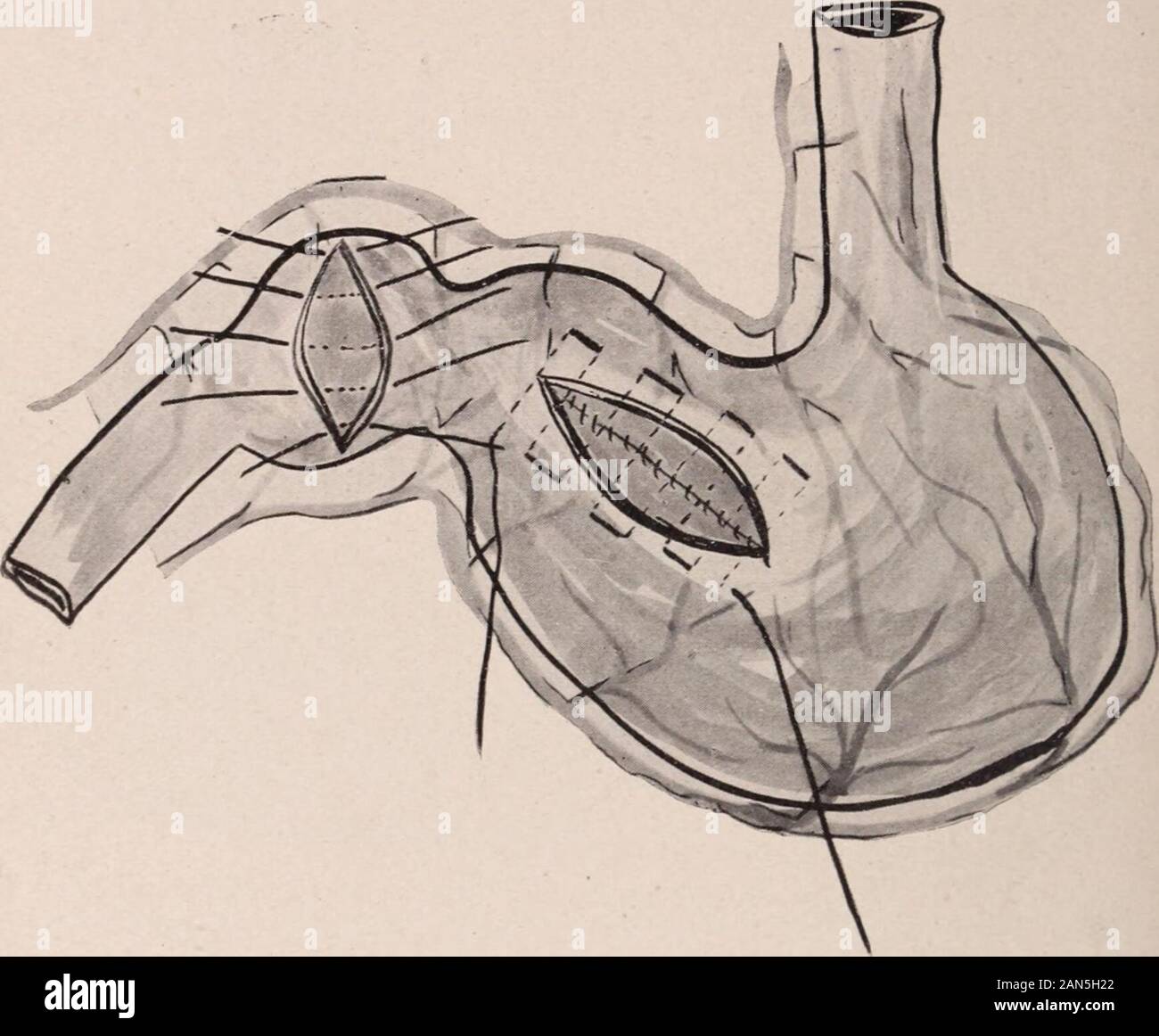 Pyloroplasty hi-res stock photography and images - Alamy