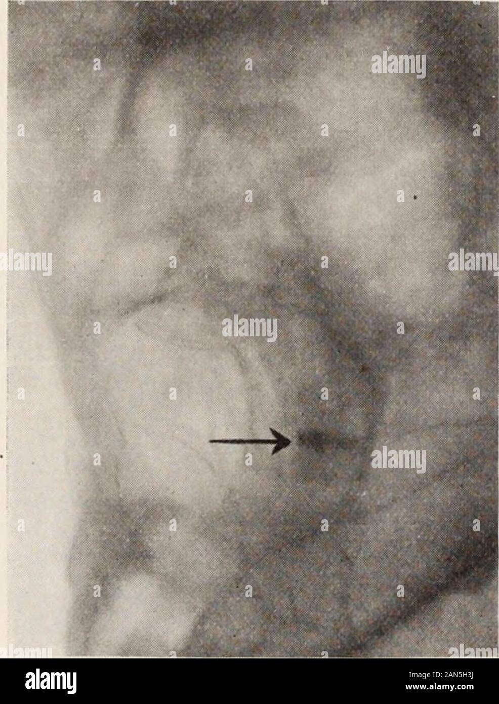 Cellulitis eye hi-res stock photography and images - Alamy