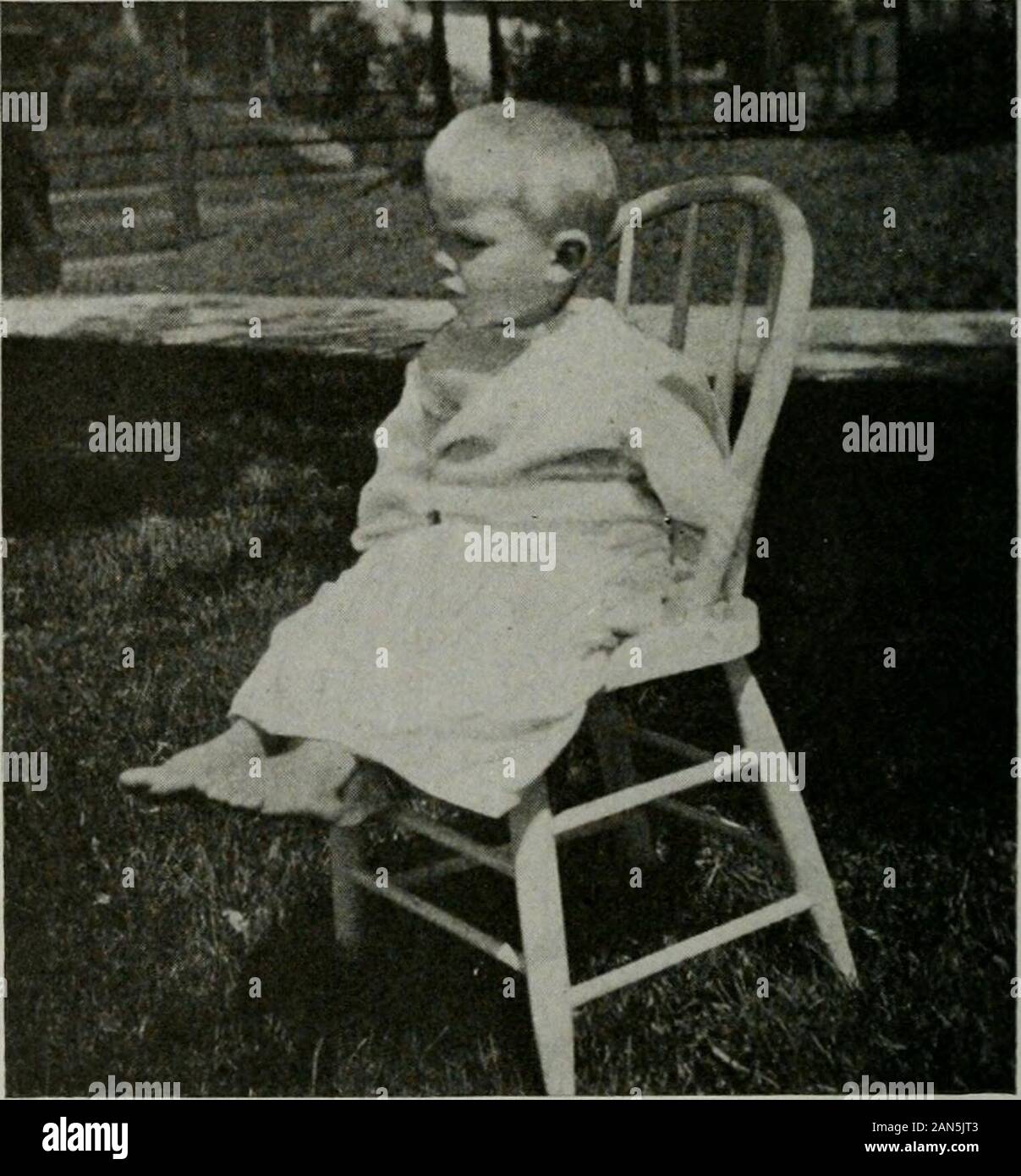 Rickets children hi-res stock photography and images - Alamy