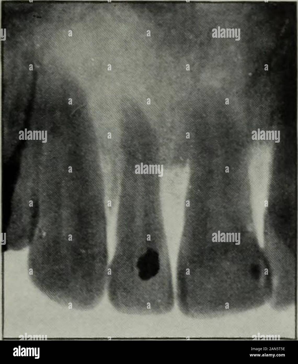 Dental x ray amalgam hi-res stock photography and images - Alamy