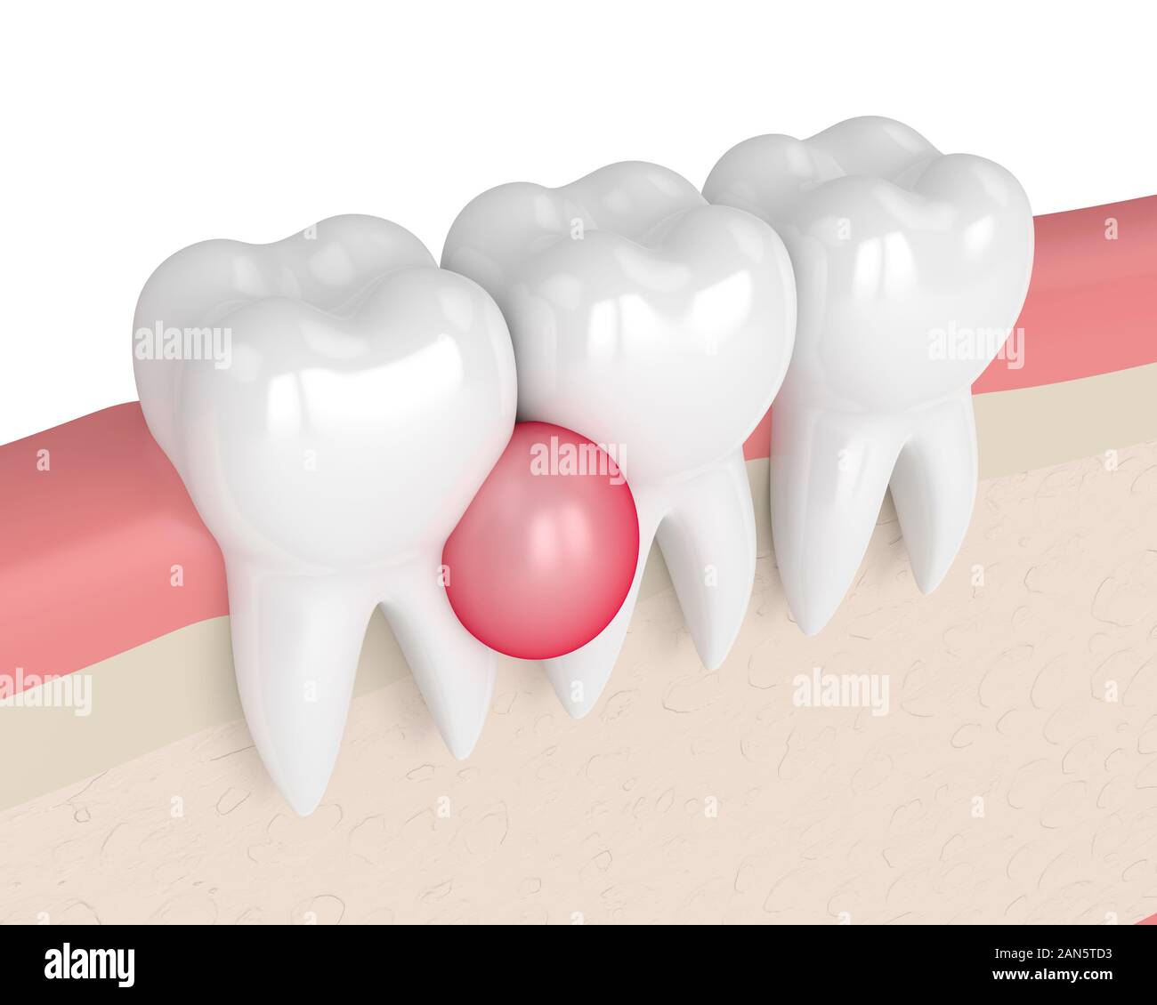 3d render of teeth in gums with cyst over white background. Dental ...