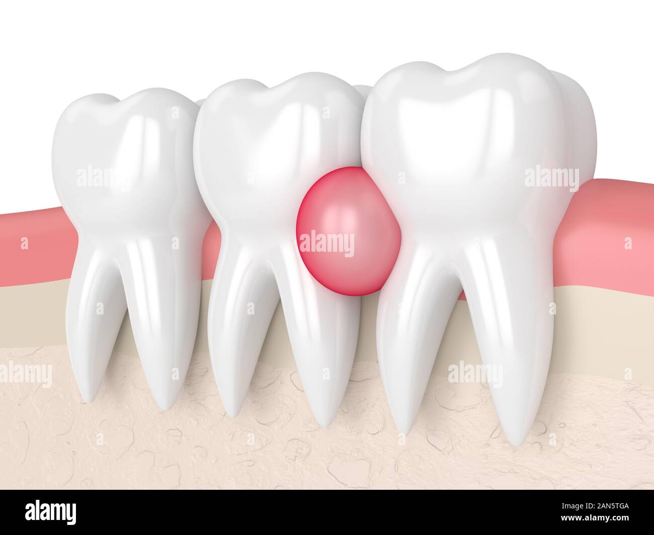 3d render of teeth in gums with cyst over white background. Dental ...
