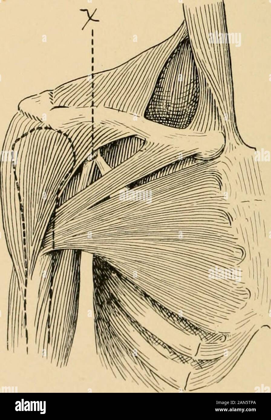 The treatment of fractures . Fig. 113.—Normal left clavicle viewed from ...