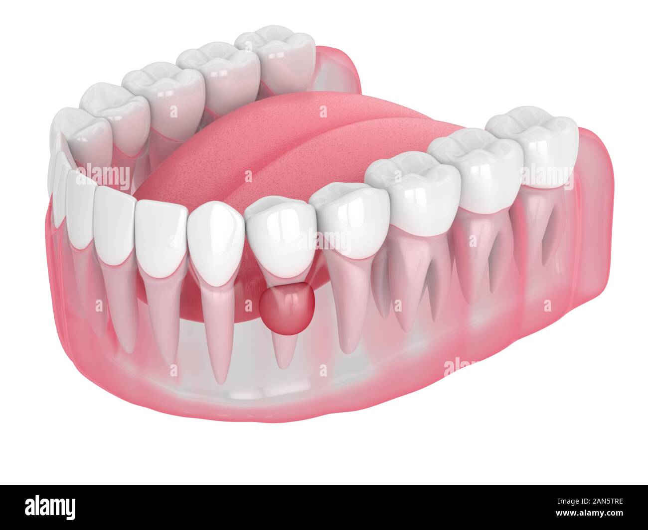 Periapical granuloma Cut Out Stock Images & Pictures - Alamy