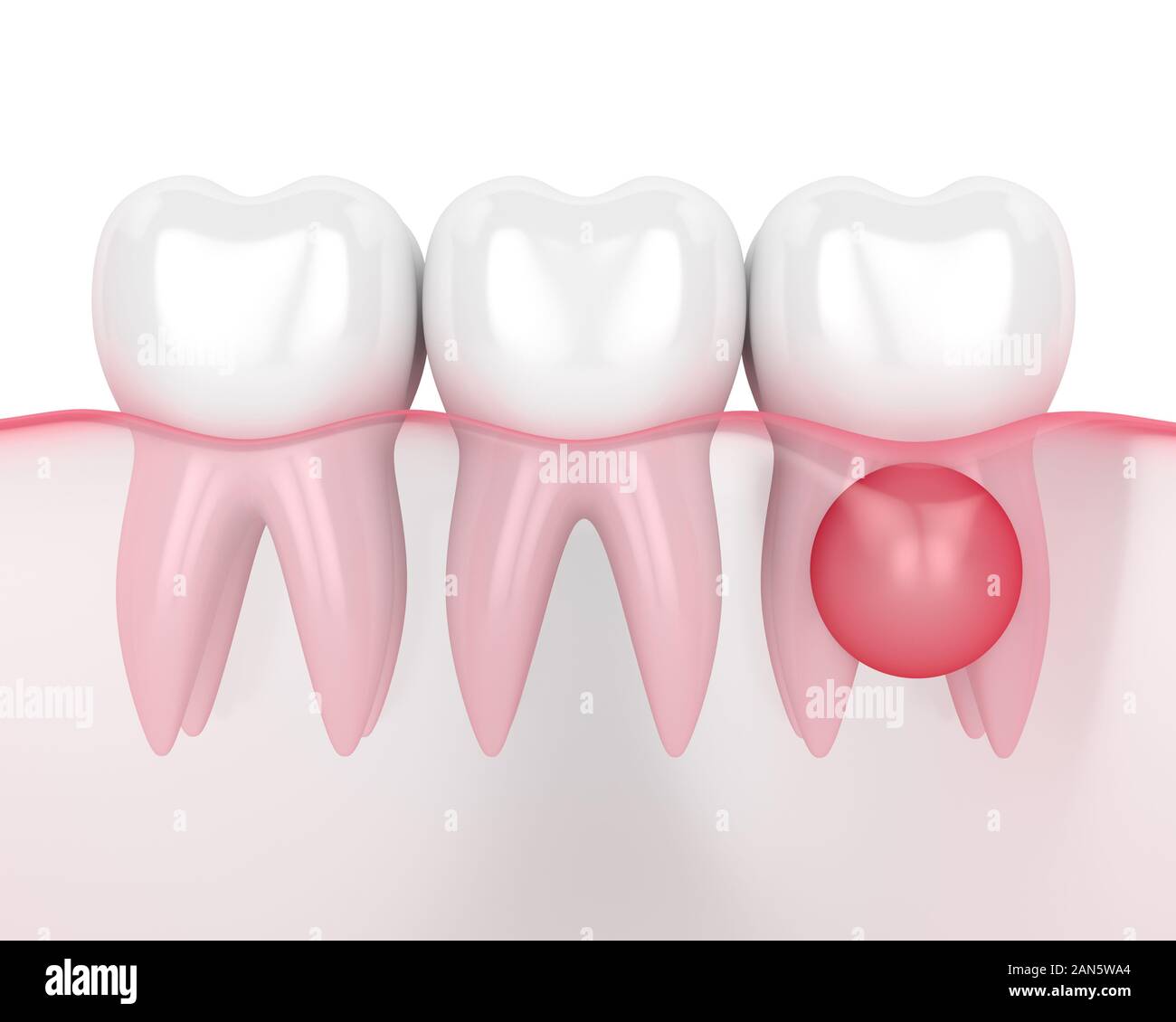 White Cyst On Gum Line