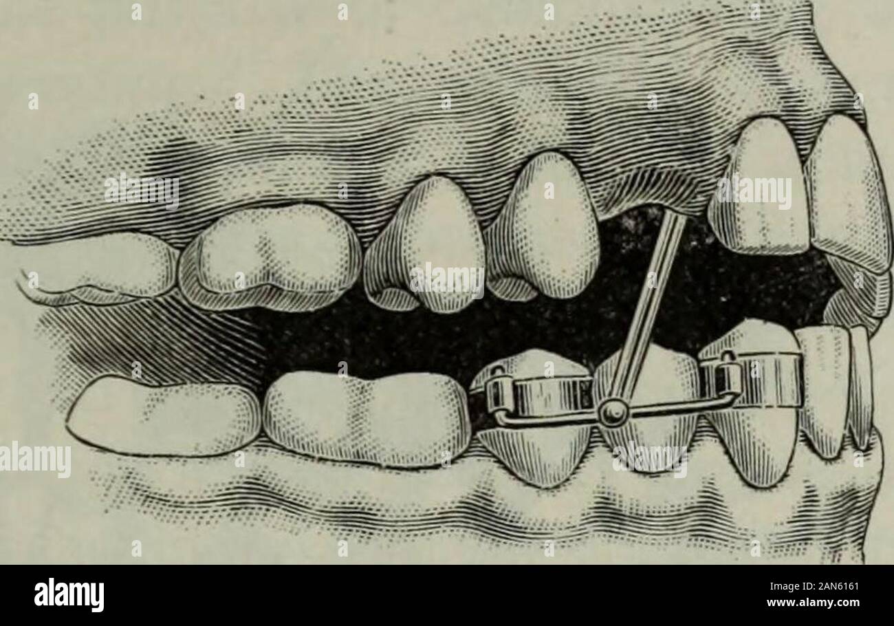 Inferior alveolar hi-res stock photography and images - Alamy