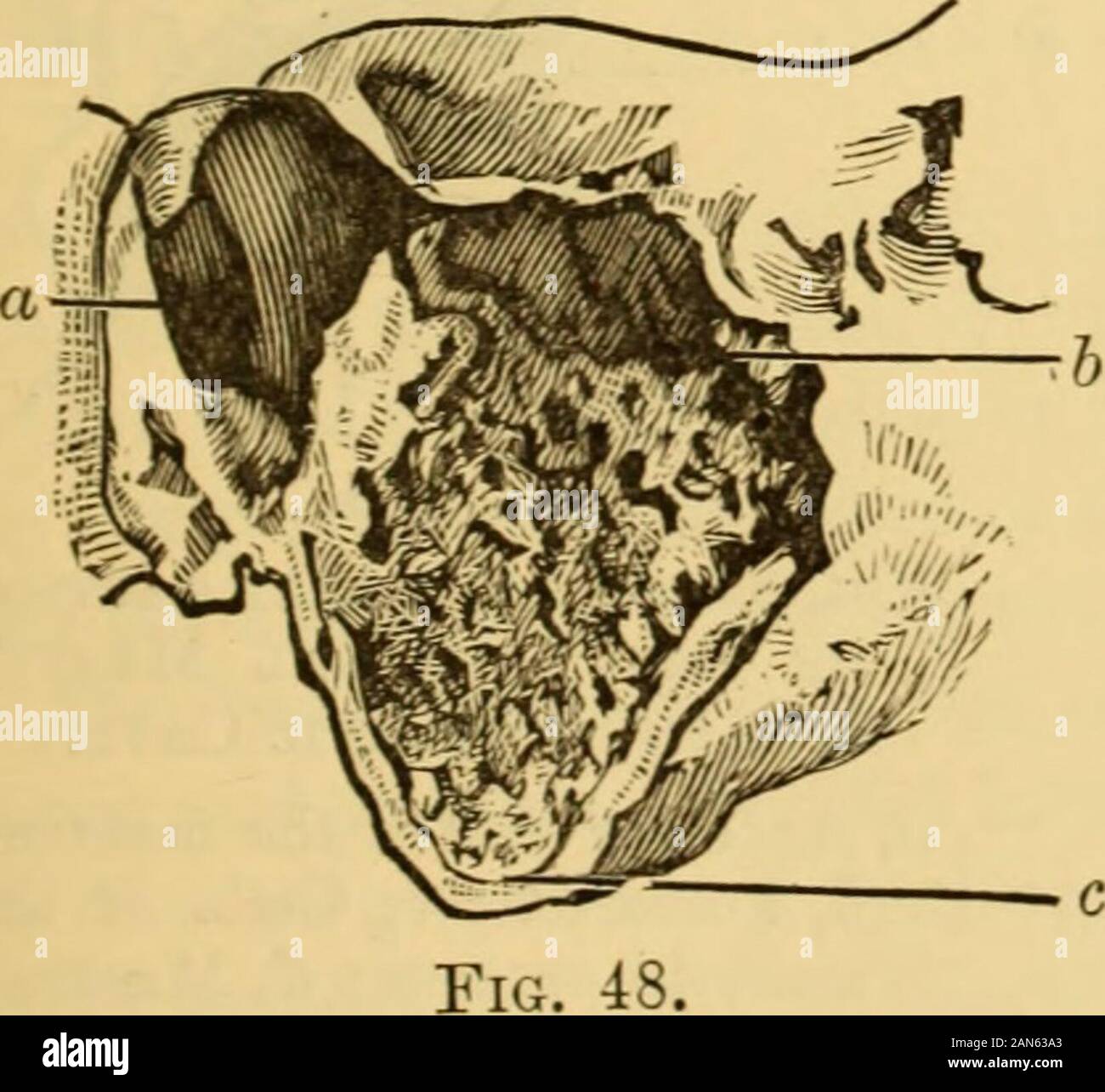 Mastoid antrum hi-res stock photography and images - Alamy